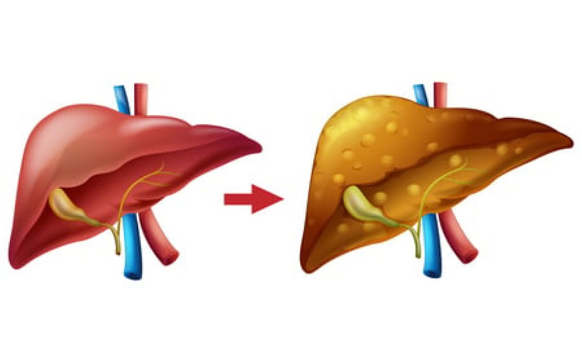 About 40 pc of participants in Phenome India Cohort may be affected by ...