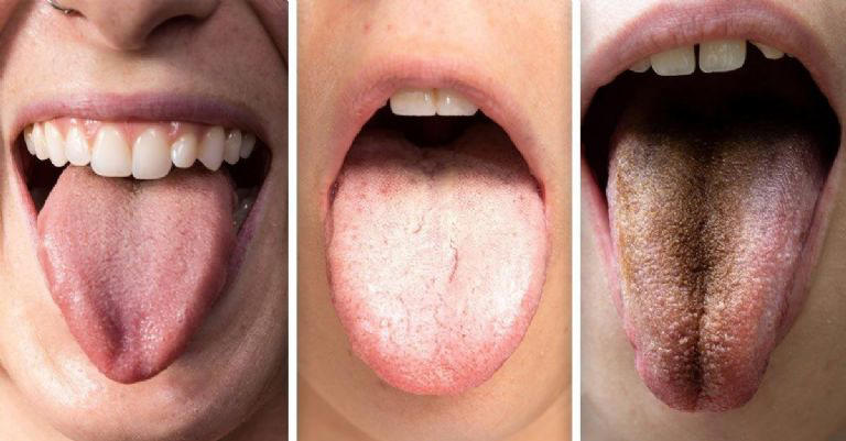 Harvard confirma que significa tener la lengua con manchas o de otro color