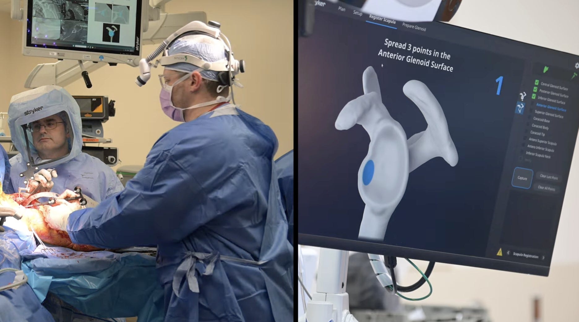 IU Health debuts robotic-assisted shoulder surgery option
