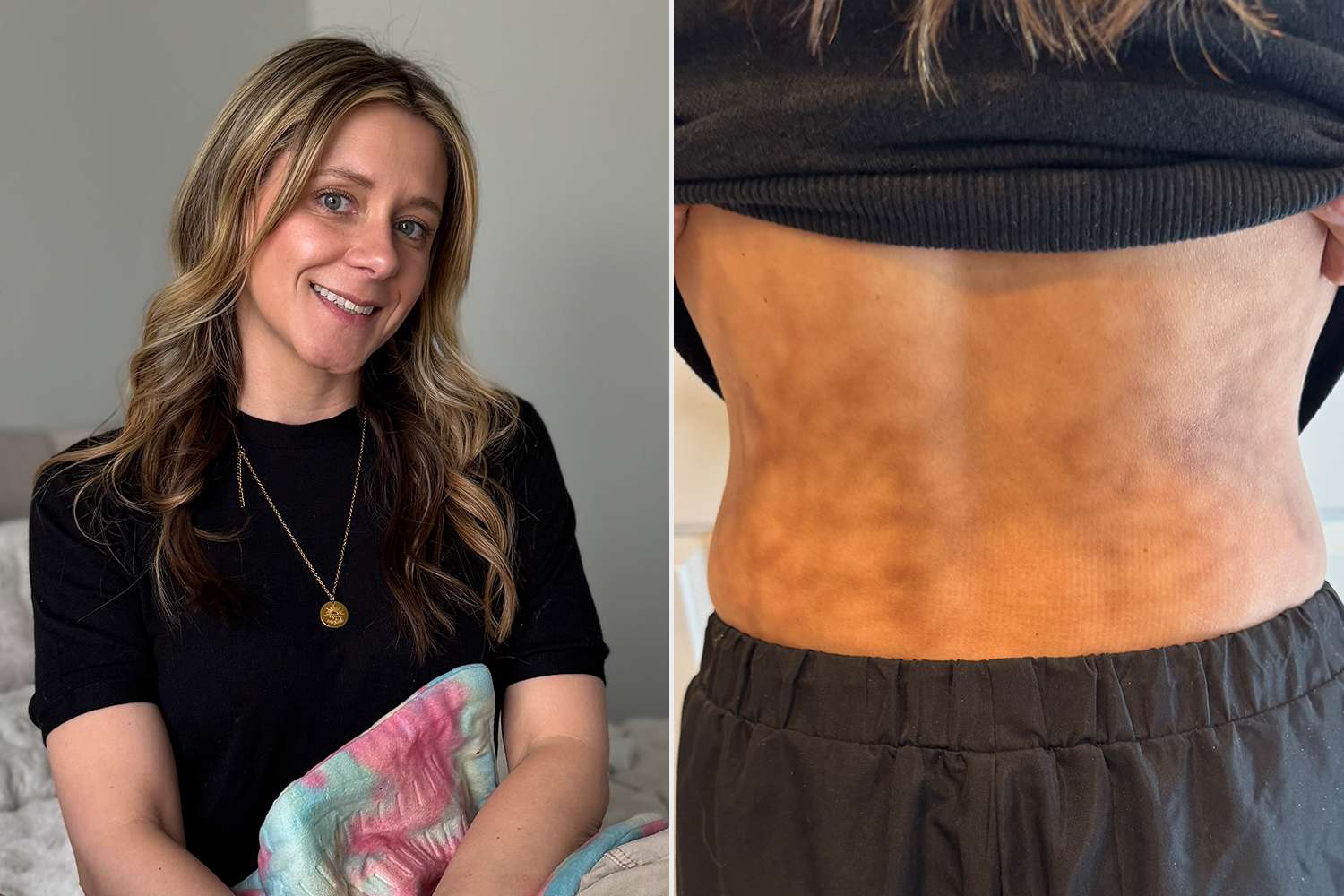 Woman 'addicted' to her heating pad 'toasted' her own skin after 6 ...