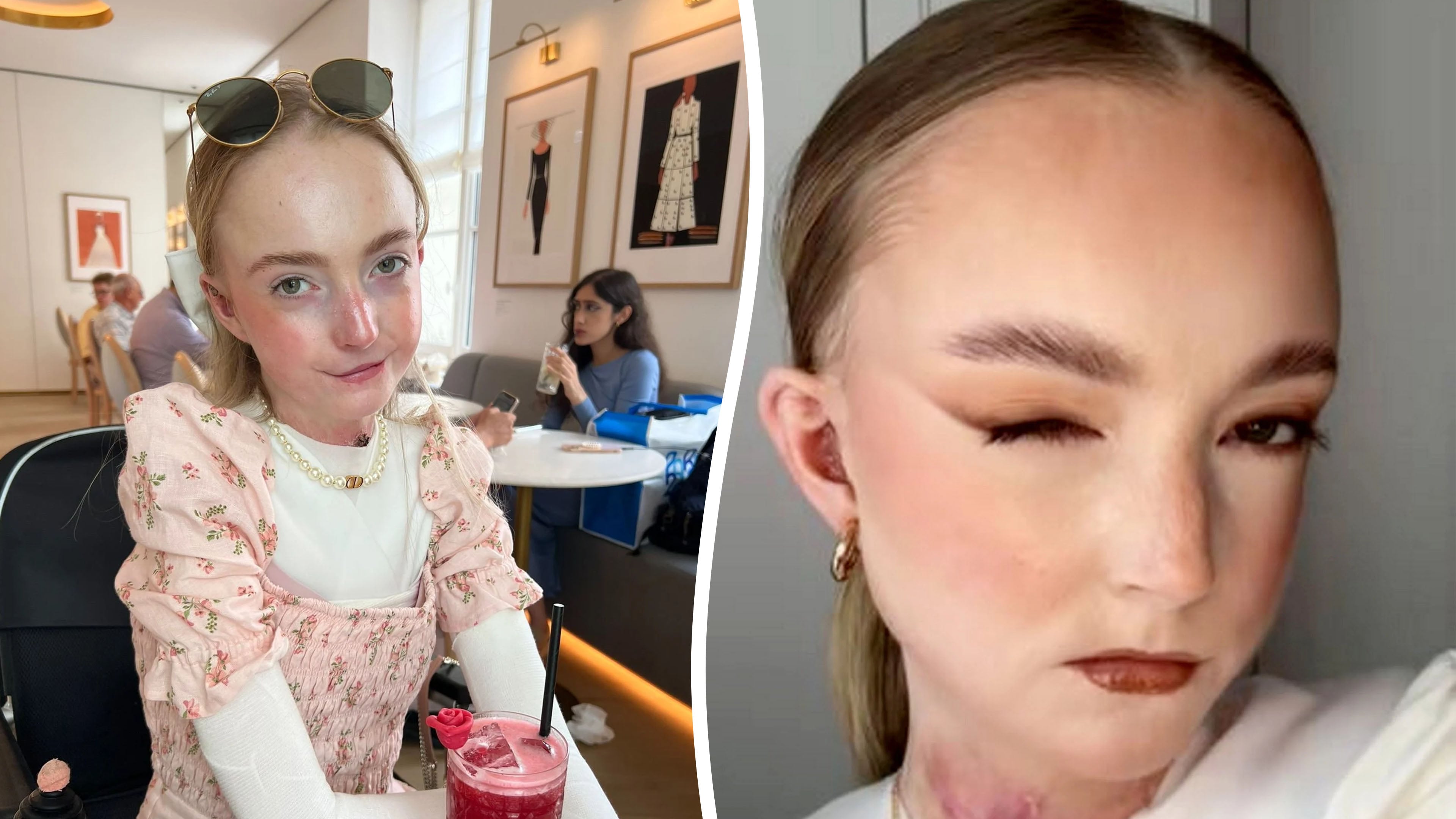 Woman has skin so fragile it's as delicate as a butterfly's wings