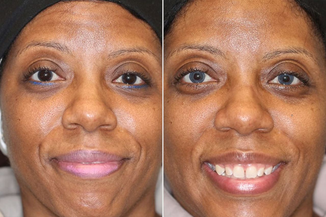 For people who always wanted a different eye color, this surgeon is ...