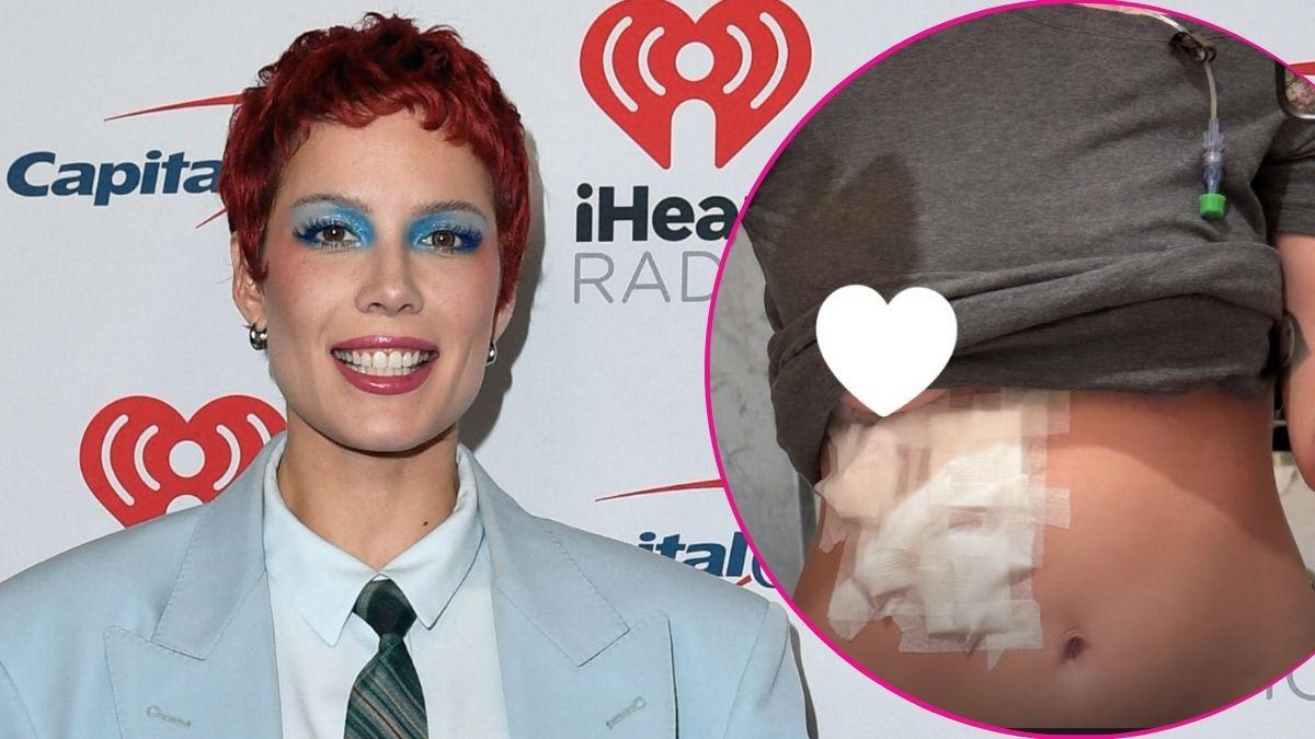 Halsey shows off recent injury after revealing she's been undergoing ...