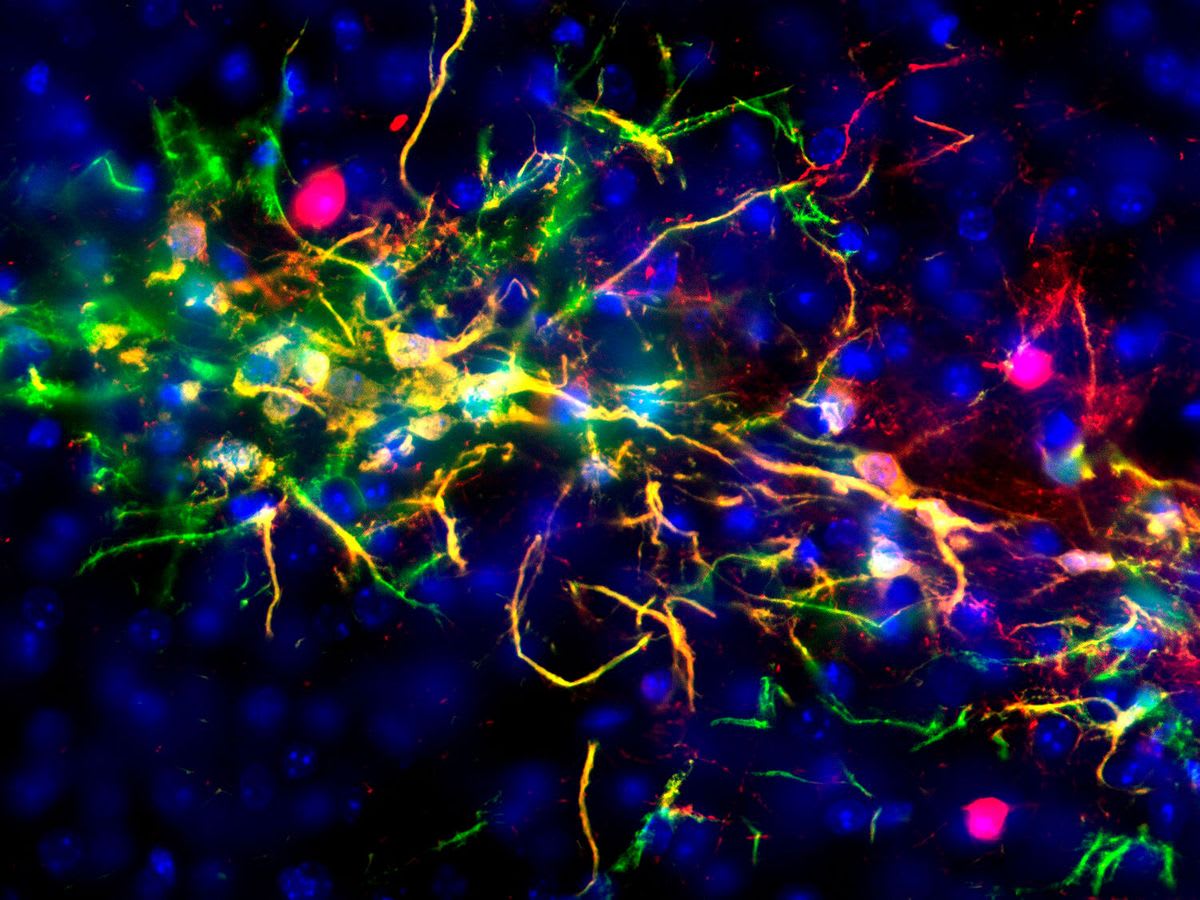 Why do more women than men get Alzheimer’s? Scientists think they’ve ...