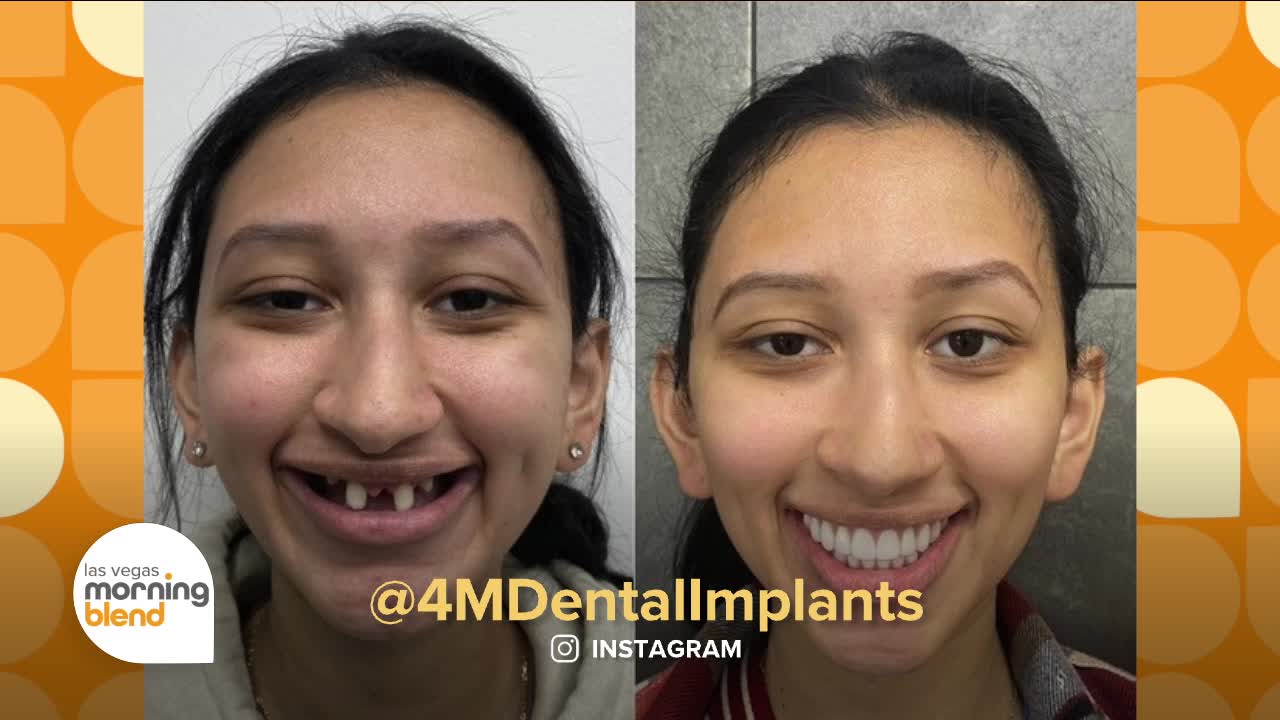 Permanent teeth in 24 hours: A new smile with Dr. Sean