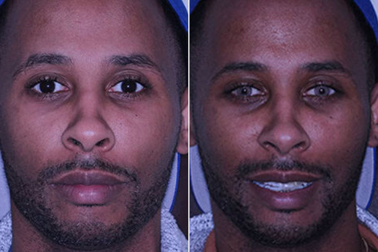 For people who always wanted a different eye color, this surgeon is ...