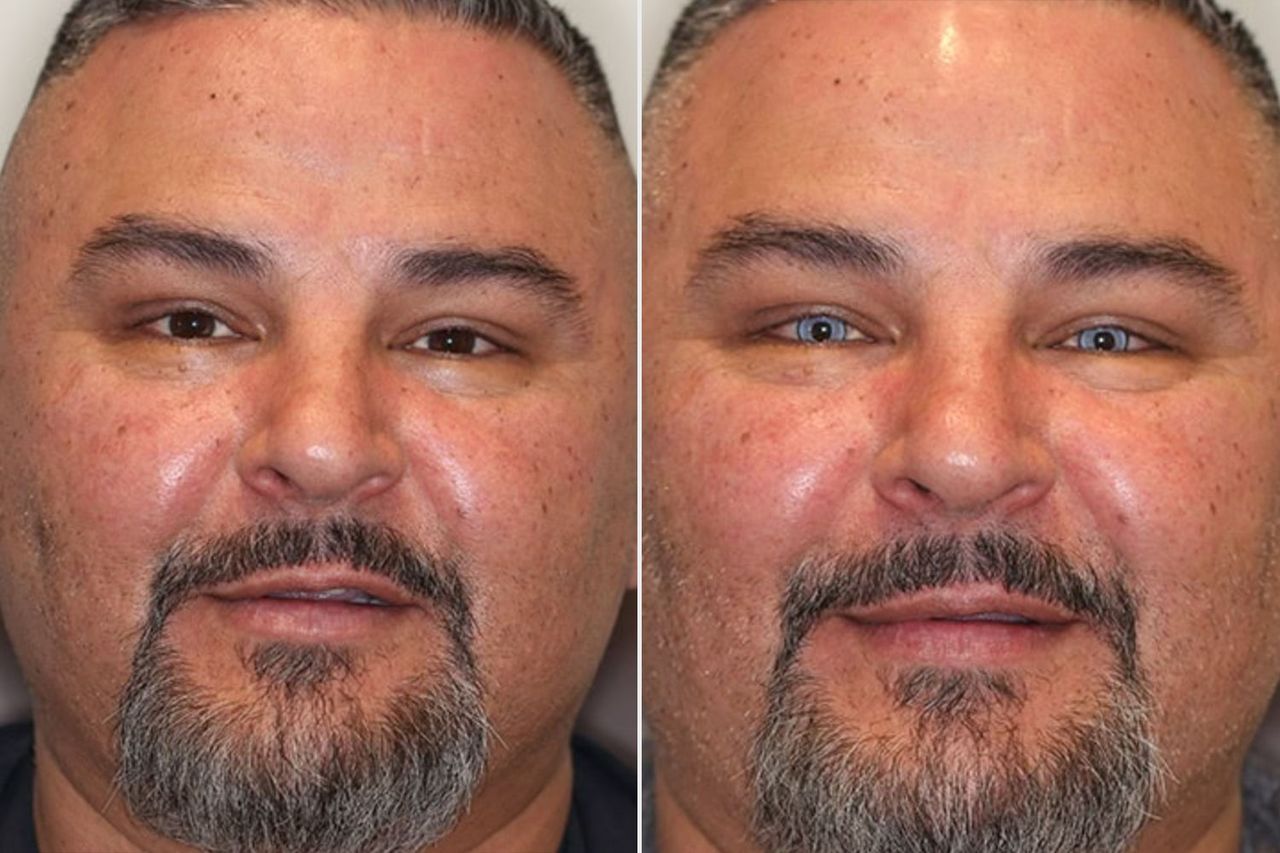 For people who always wanted a different eye color, this surgeon is ...