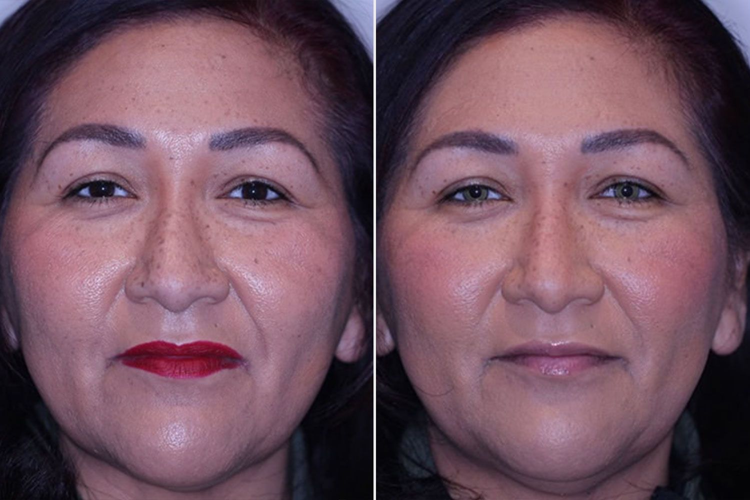 For people who always wanted a different eye color, this surgeon is ...