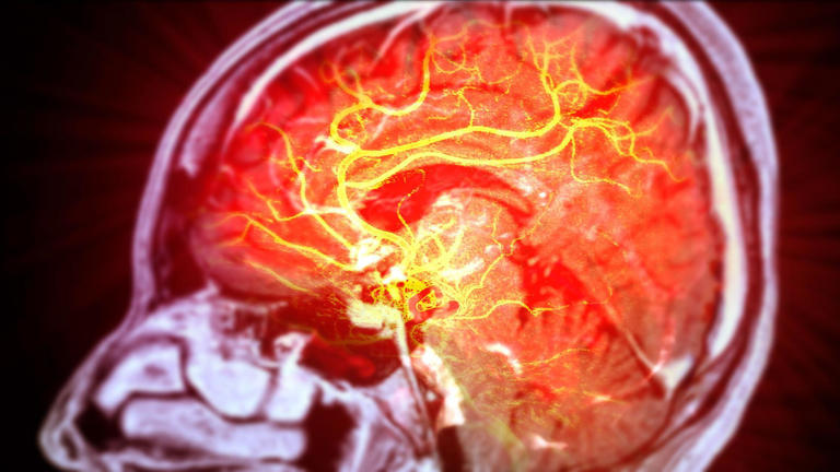 I had a stroke while napping - it was terrifying