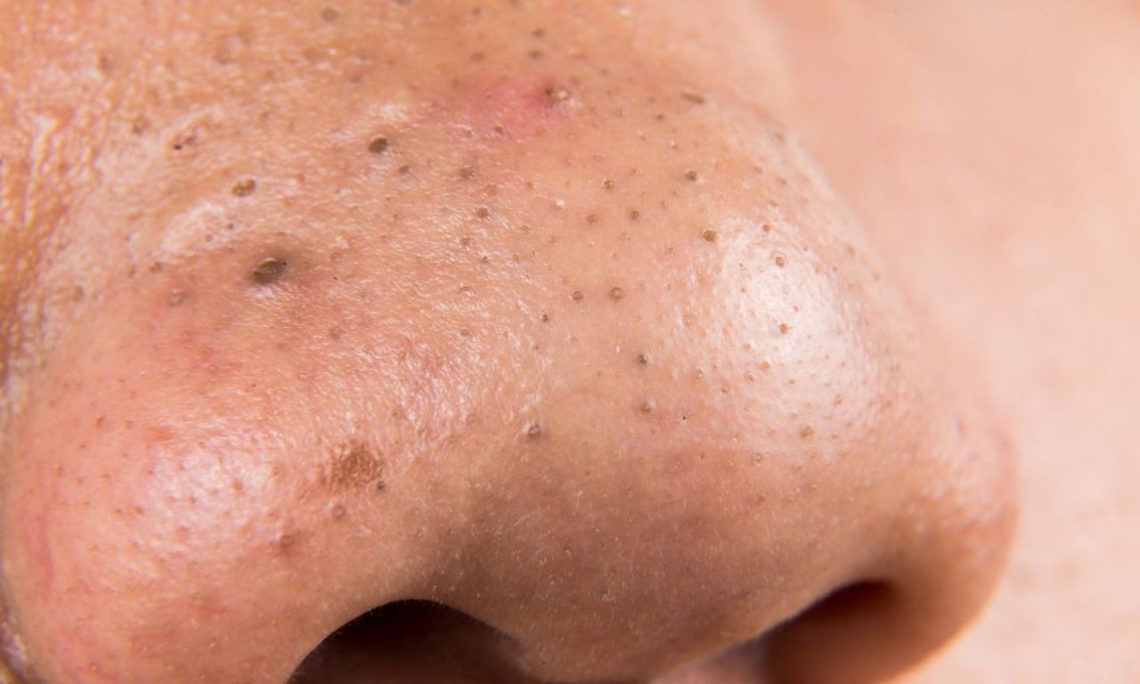 Cómo eliminar los puntos negros del rostro: paso a paso