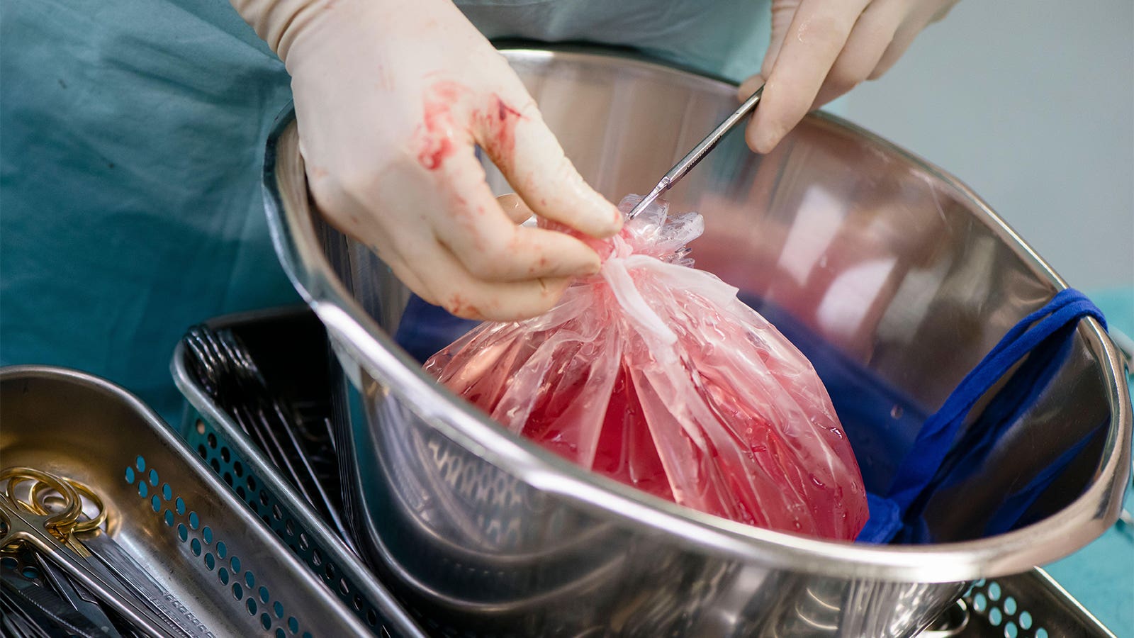 CMS makes push to maximize donor organs, even the imperfect ones