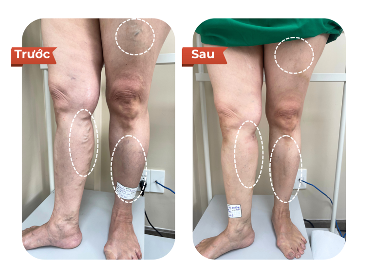 Dr Vein applies advanced technology in varicose vein treatment