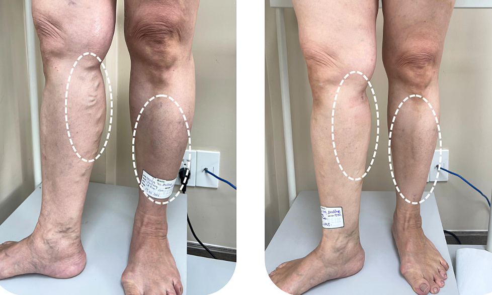 Dr. Vein applies advanced technology in varicose vein treatment