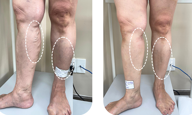 Dr. Vein applies advanced technology in varicose vein treatment