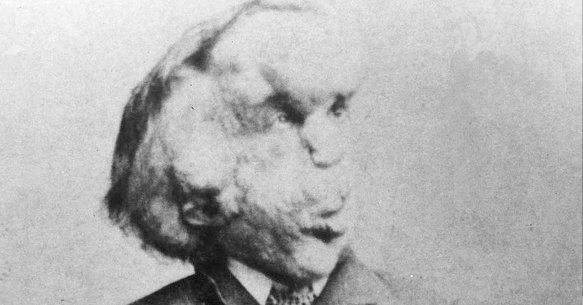 The heartbreaking story of the Elephant Man