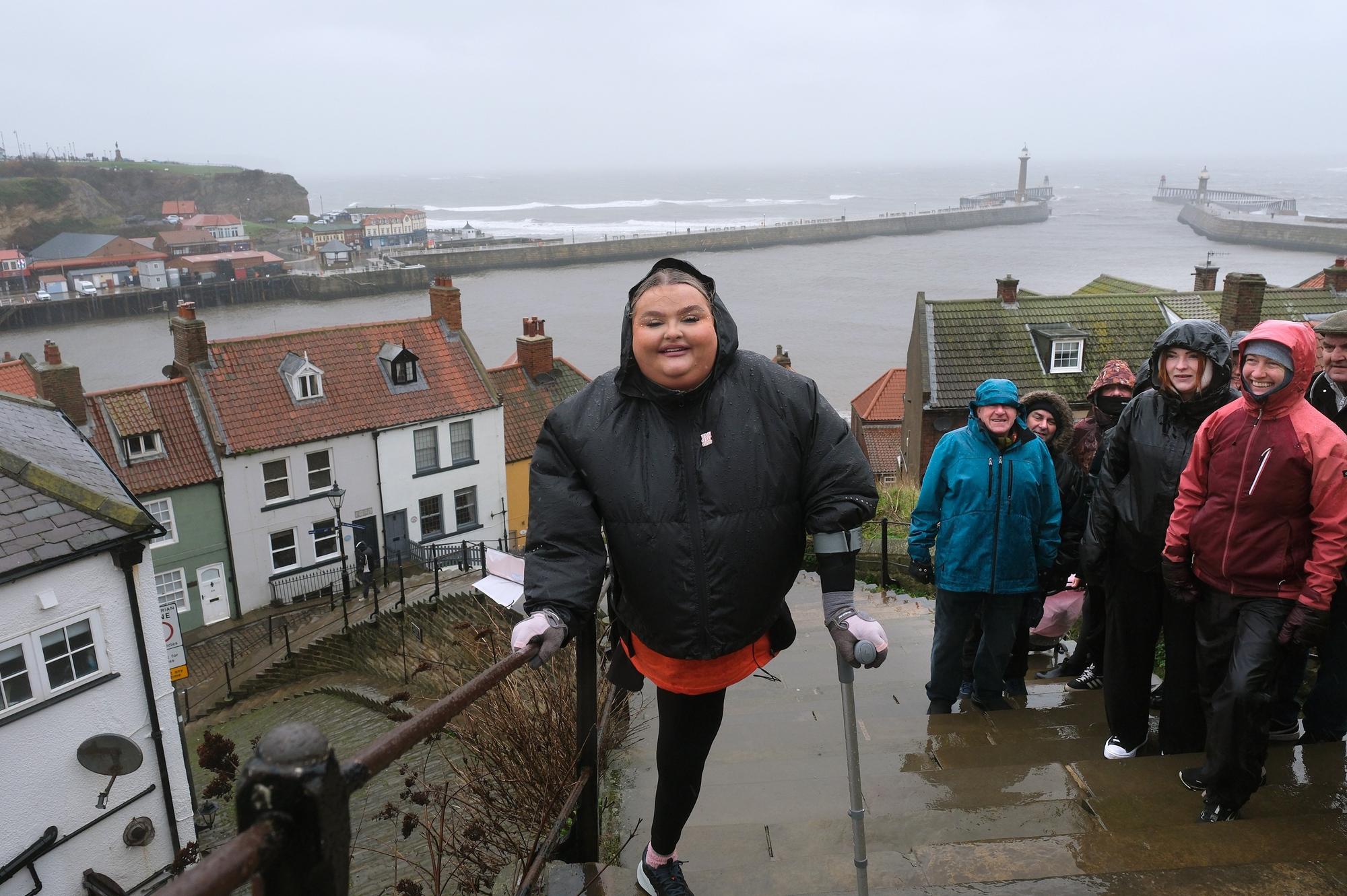 Woman with one leg after tractor accident hops up Whitby's famous steps ...