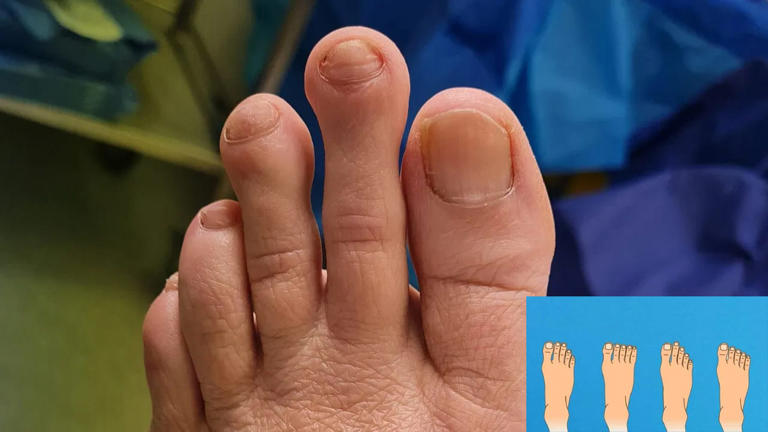 Long toes meaning: కాలు వేళ్లు పొడవుగా ఉన్నాయా? వీరంతా అదృష్టవంతులే!