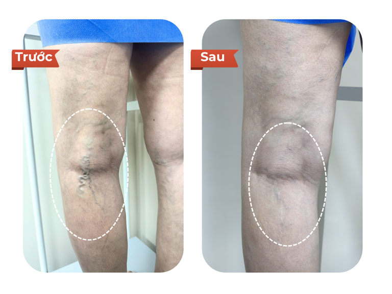 Dr Vein applies advanced technology in varicose vein treatment