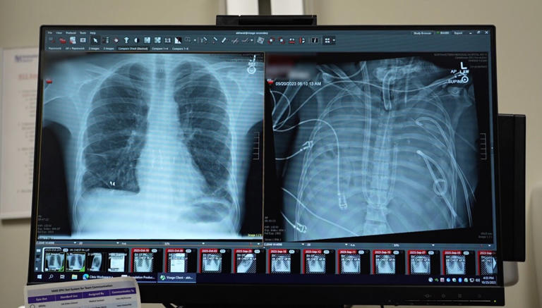Artificial lung system keeps patient alive without lungs until transplant