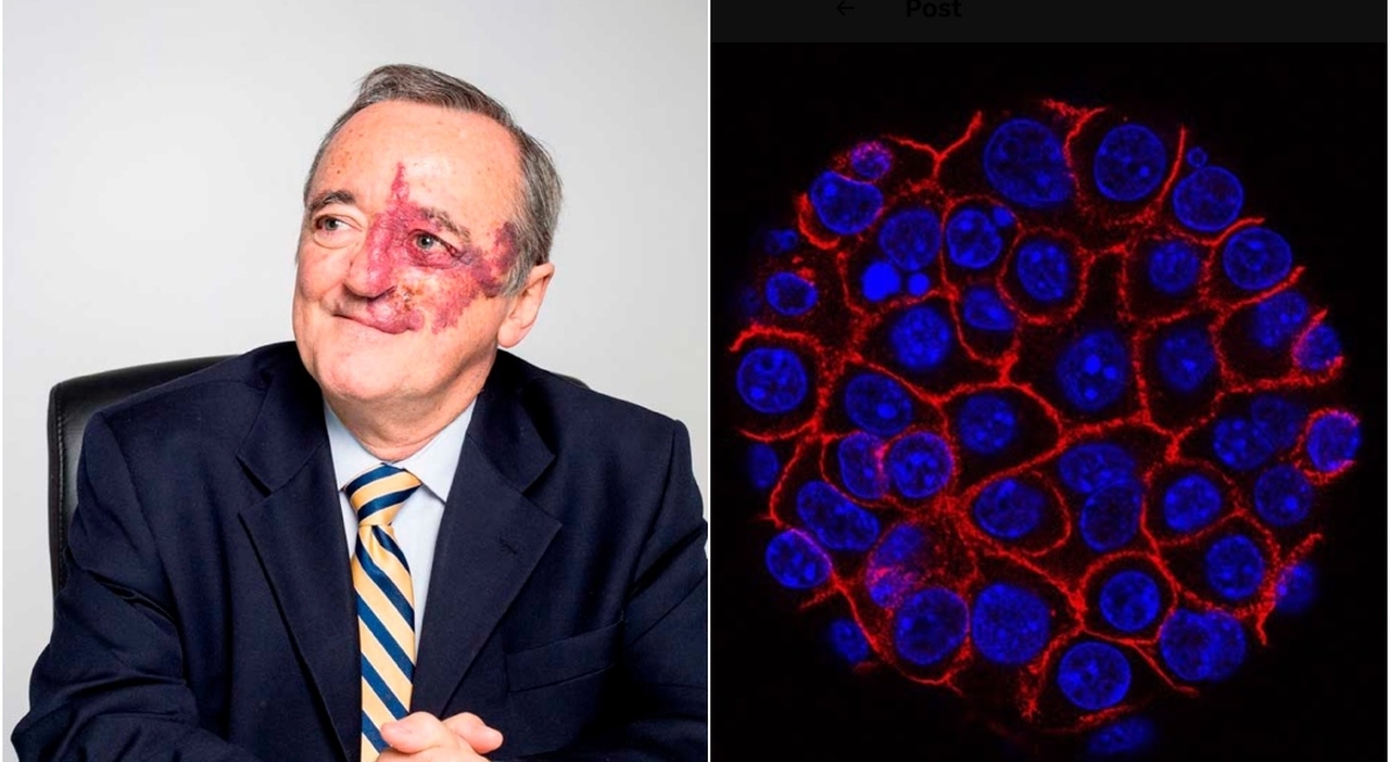 Tumore al pancreas, oncologo spagnolo trova la cura: combinazione di 3 ...