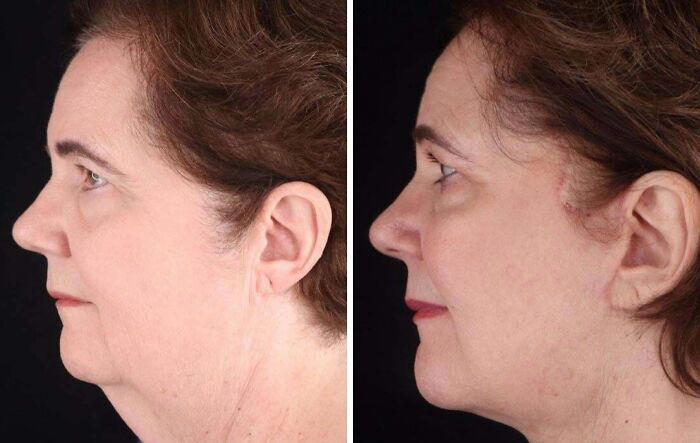 38 striking before-and-after photos of plastic surgery that seriously ...