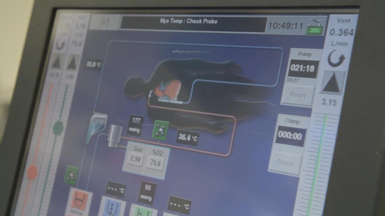 Artificial lung system keeps patient alive without lungs until transplant