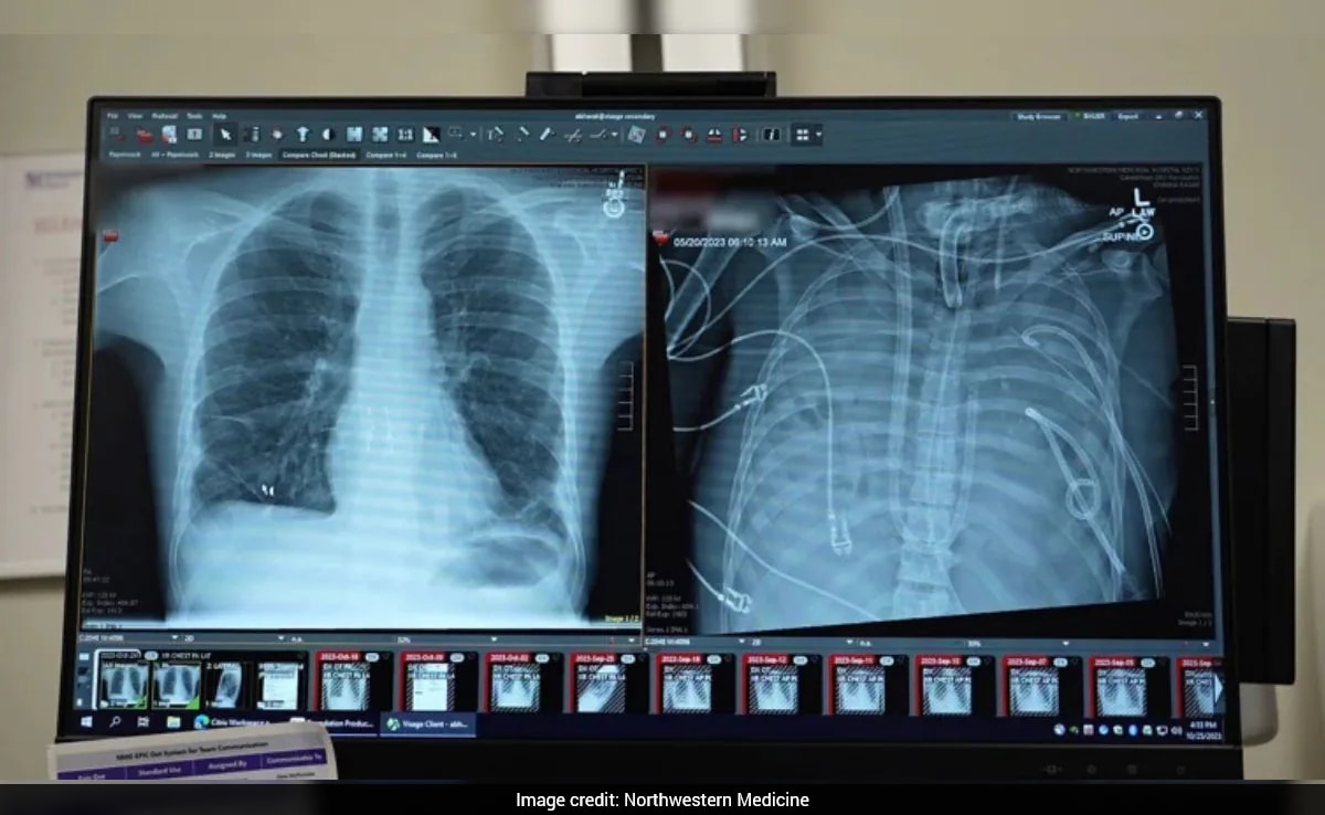Man miraculously survives 48 hours without lungs before transplant
