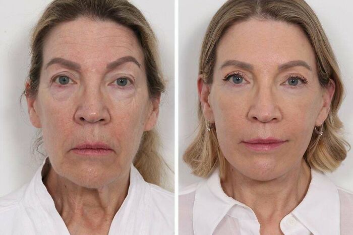 38 striking before-and-after photos of plastic surgery that seriously ...