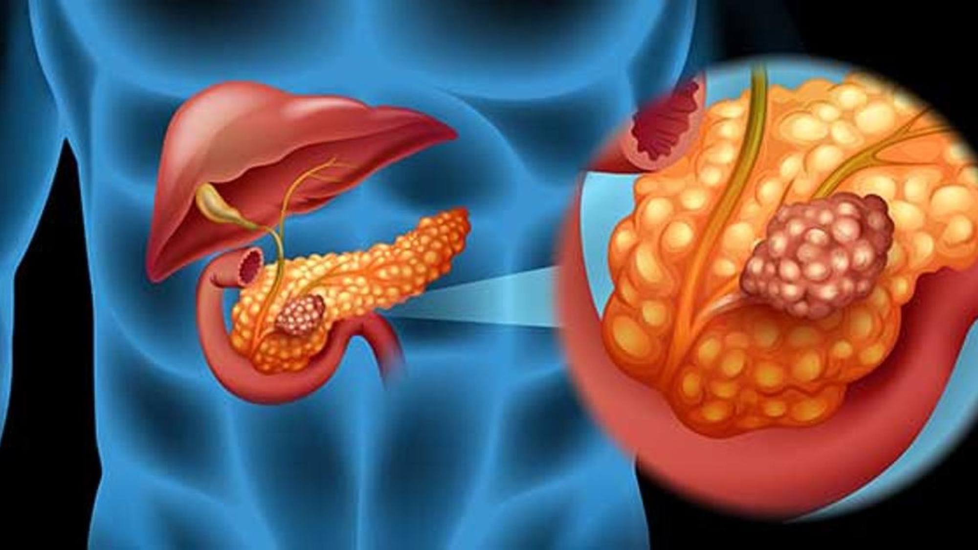 Nuevas esperanzas: científicos logran eliminar cáncer de páncreas en ...