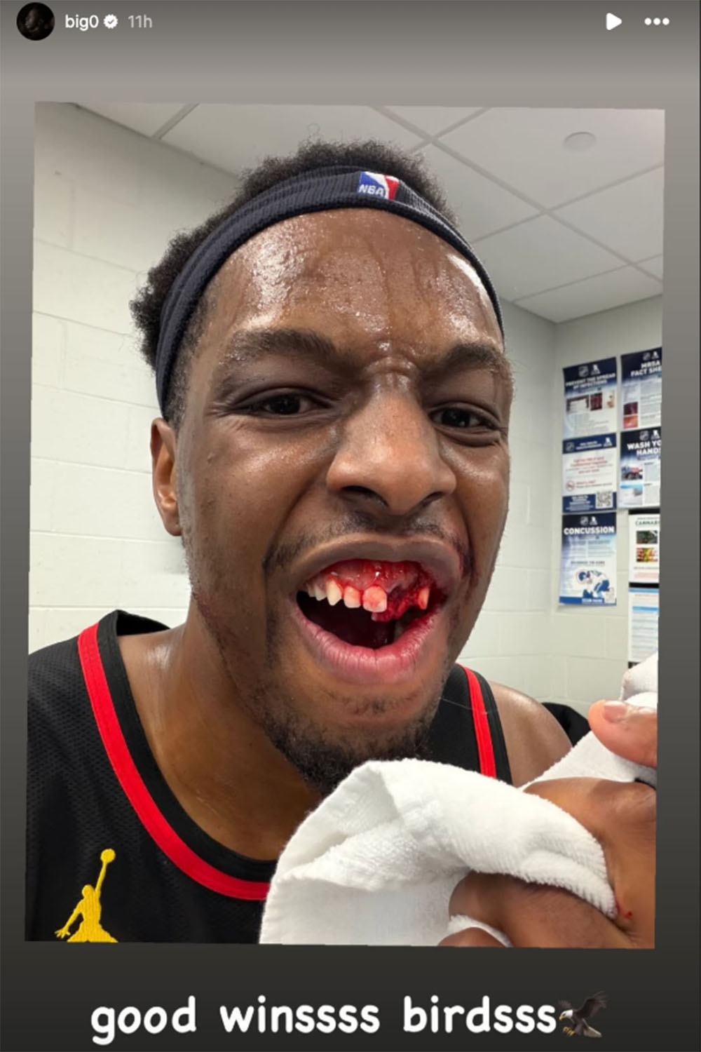 Bloodied Onyeka Okongwu shows off gruesome injury after taking elbow to ...