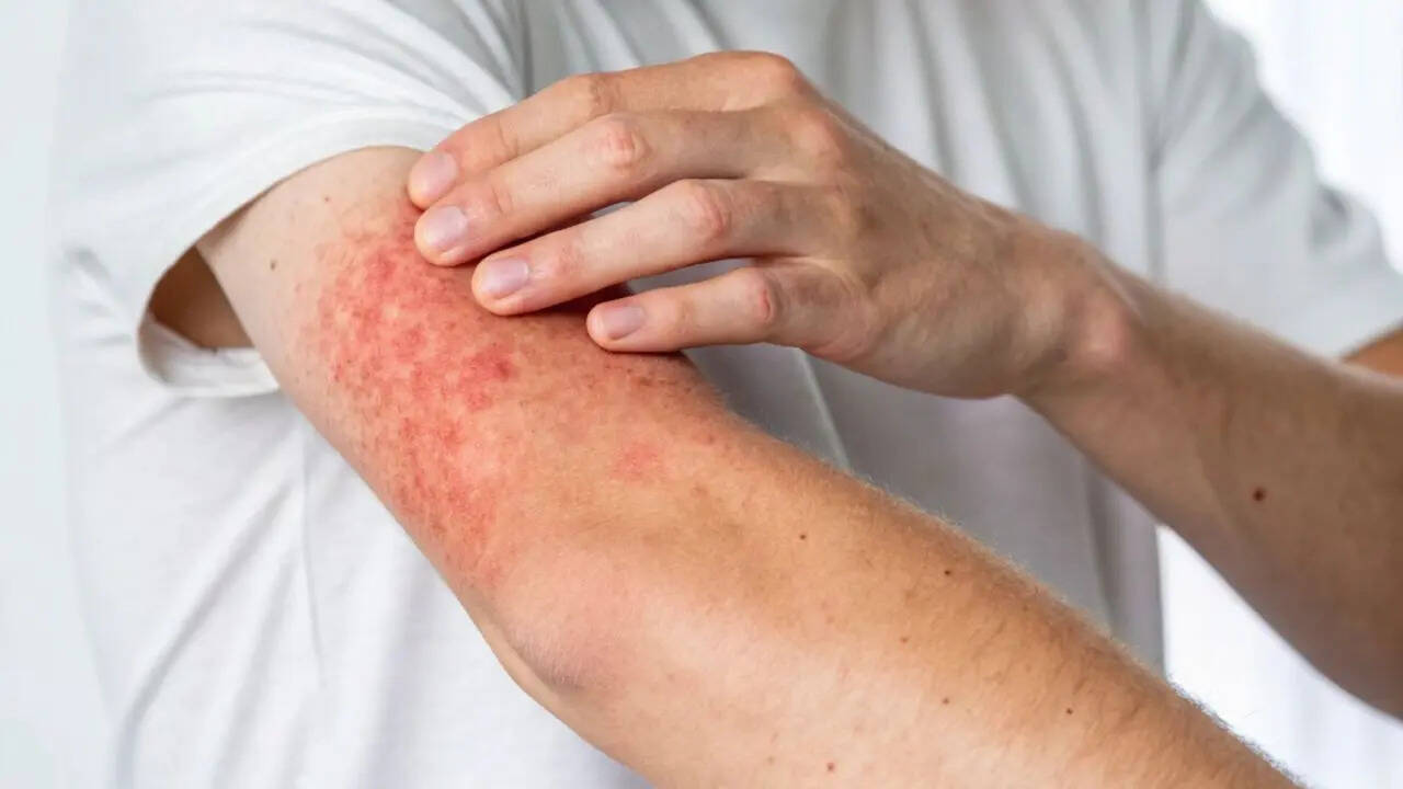 What is cold urticaria? Doctors warn of painful allergy caused by cold ...