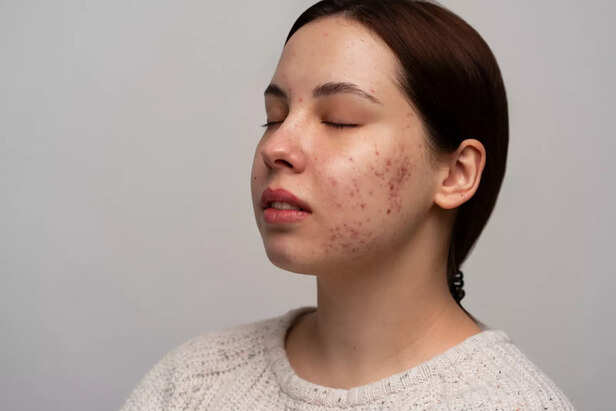 Know how to hide facial scars with makeup