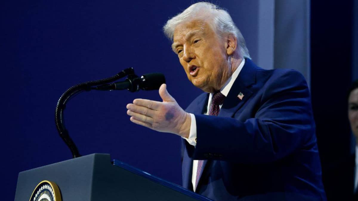 Prez Trump’s big blue bruise explained: Doctors say this could be the ...