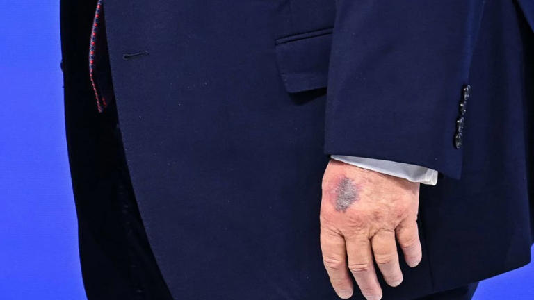 Prez Trump’s big blue bruise explained: Doctors say this could be the ...