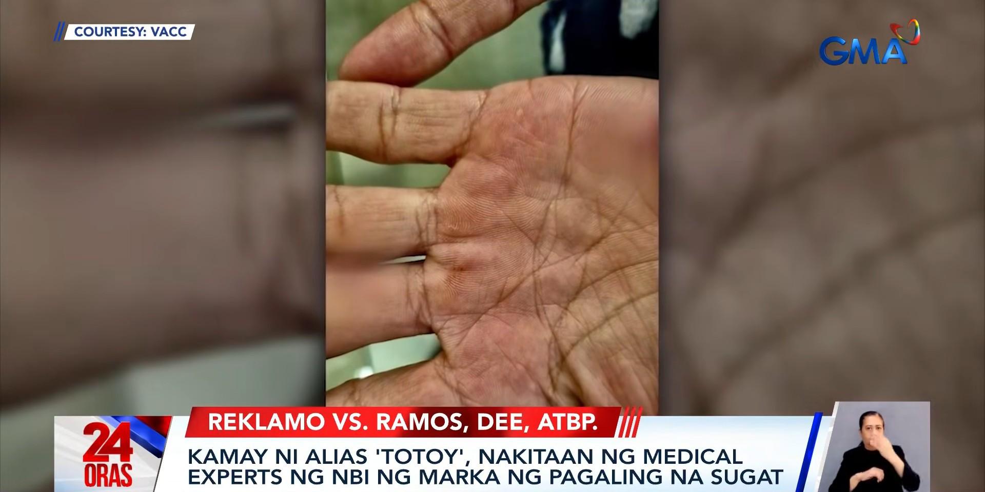 NBI experts find healing marks on hand of Rhian Ramos’ driver; Michelle ...