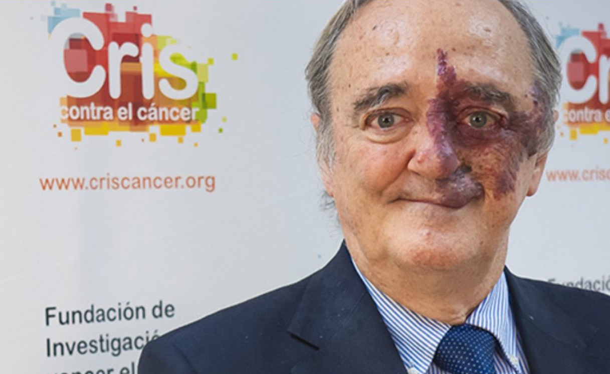 Cancro al pancreas «eliminato», la scoperta di Mariano Barbacid: così ...