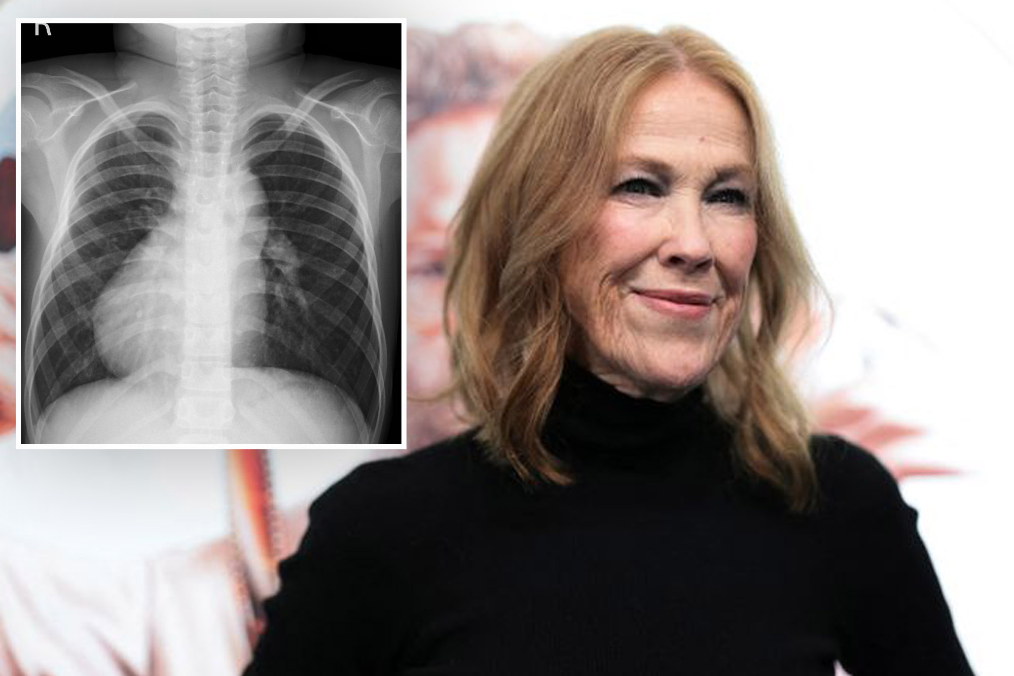 What is dextrocardia? Catherine O’Hara’s rare heart condition as ...