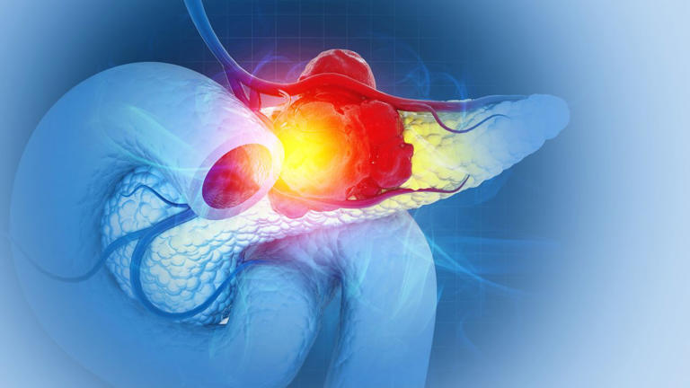 New triple-drug treatment stops pancreatic cancer in its tracks, a ...