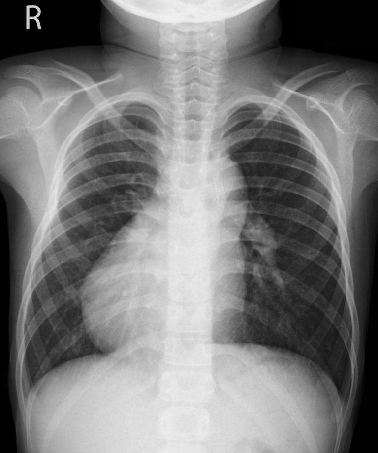 What is dextrocardia? Catherine O’Hara’s rare heart condition as ...