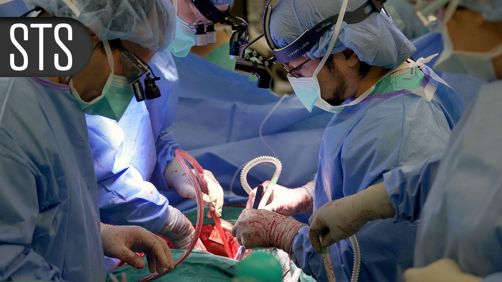 CT-guided CABG trial feeds early enthusiasm