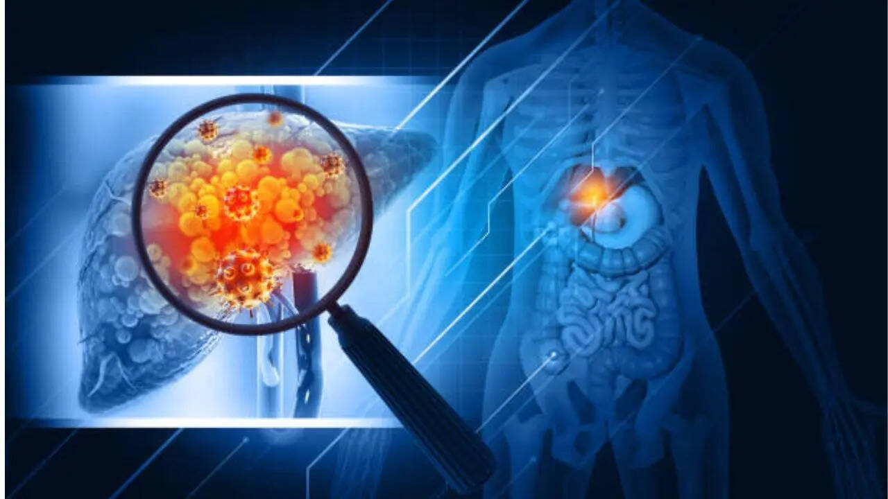 From fatty liver to liver cancer: How doctors treated a high-risk ...