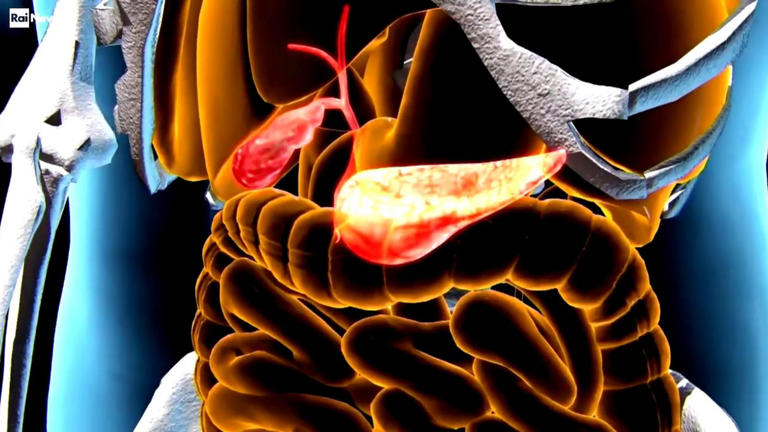 Tumore al pancreas, oltre 13mila nuove diagnosi nel 2024