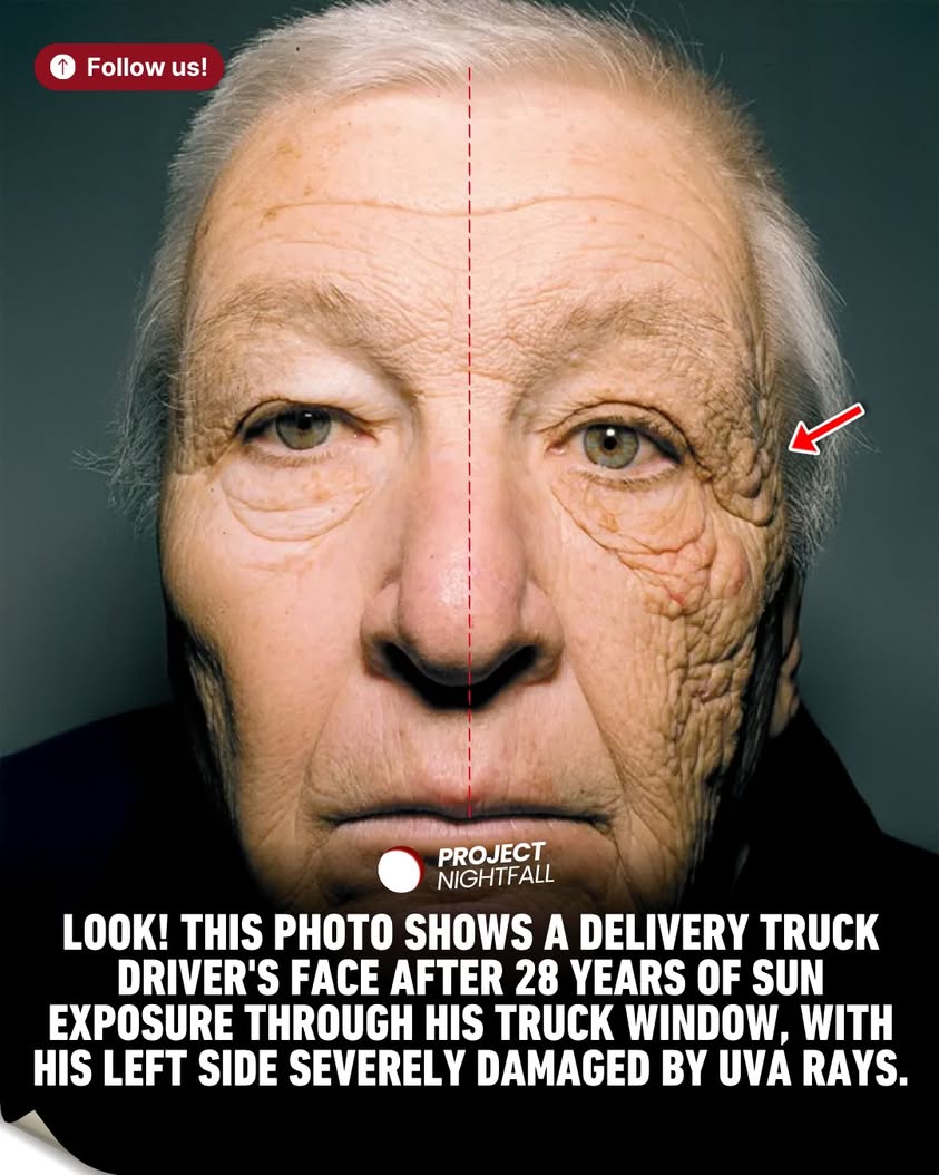 This 69-year-old truck driver developed a condition called unilateral ...
