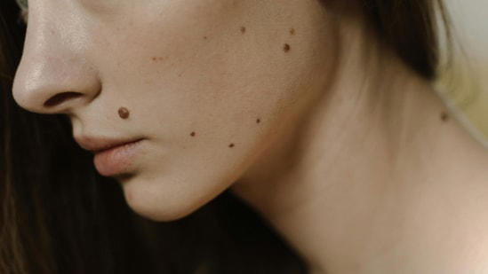 Physician explains why you shouldn't cut or burn off skin moles instead ...