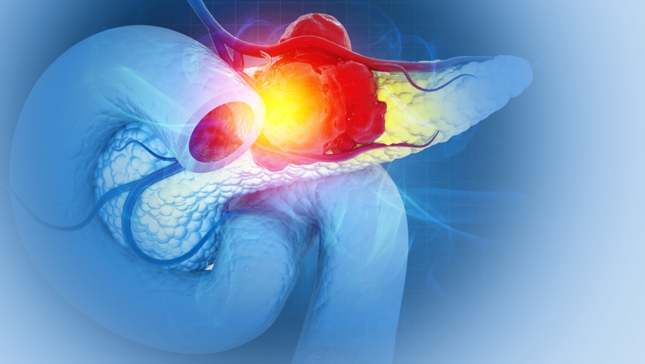 Tumore al pancreas: scoperto in Spagna un mix di tre farmaci che ...