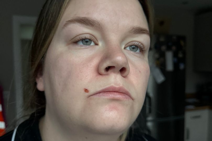 Walsall mum awarded £10k after dentist 'burns face with drill'