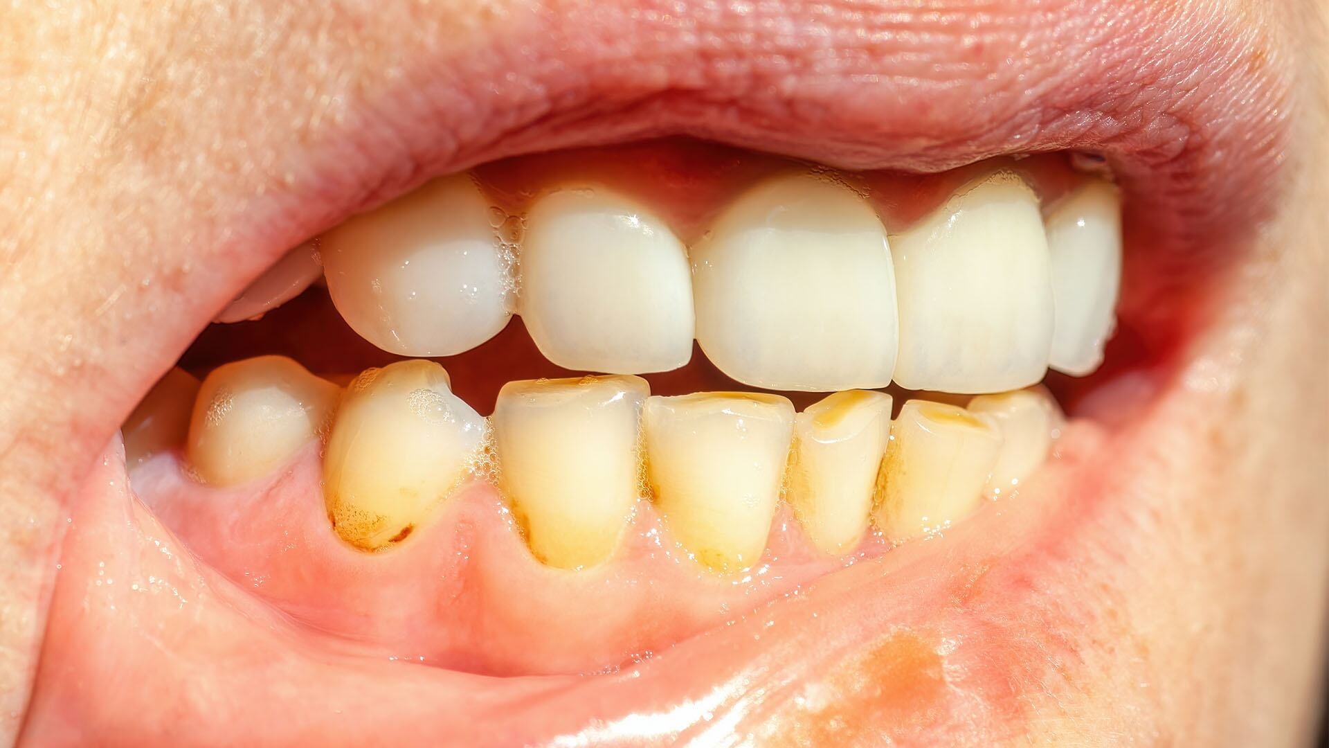 Ni bicarbonato ni vinagre: el truco para sacar el sarro de los dientes ...