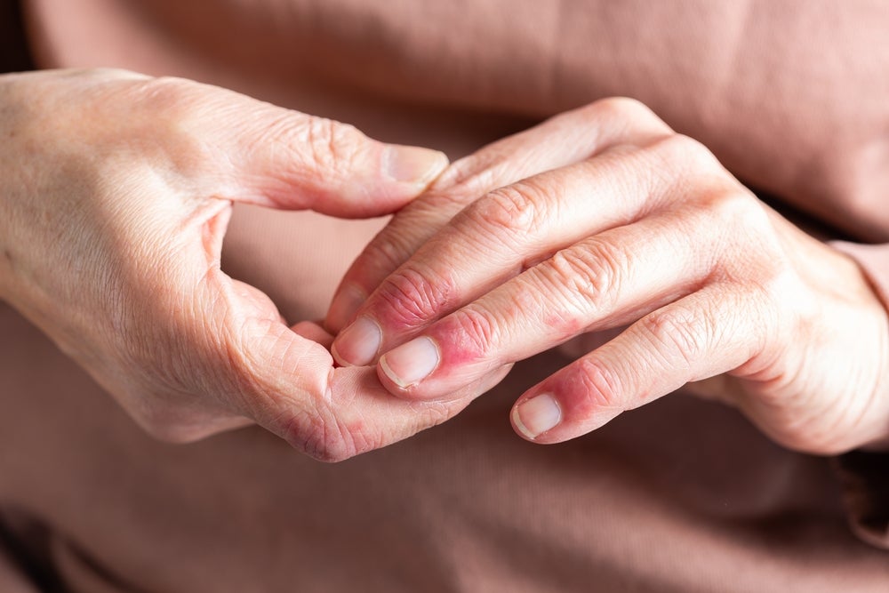 Amgen hands back eczema drug to Kyowa Kirin despite positive late-stage ...