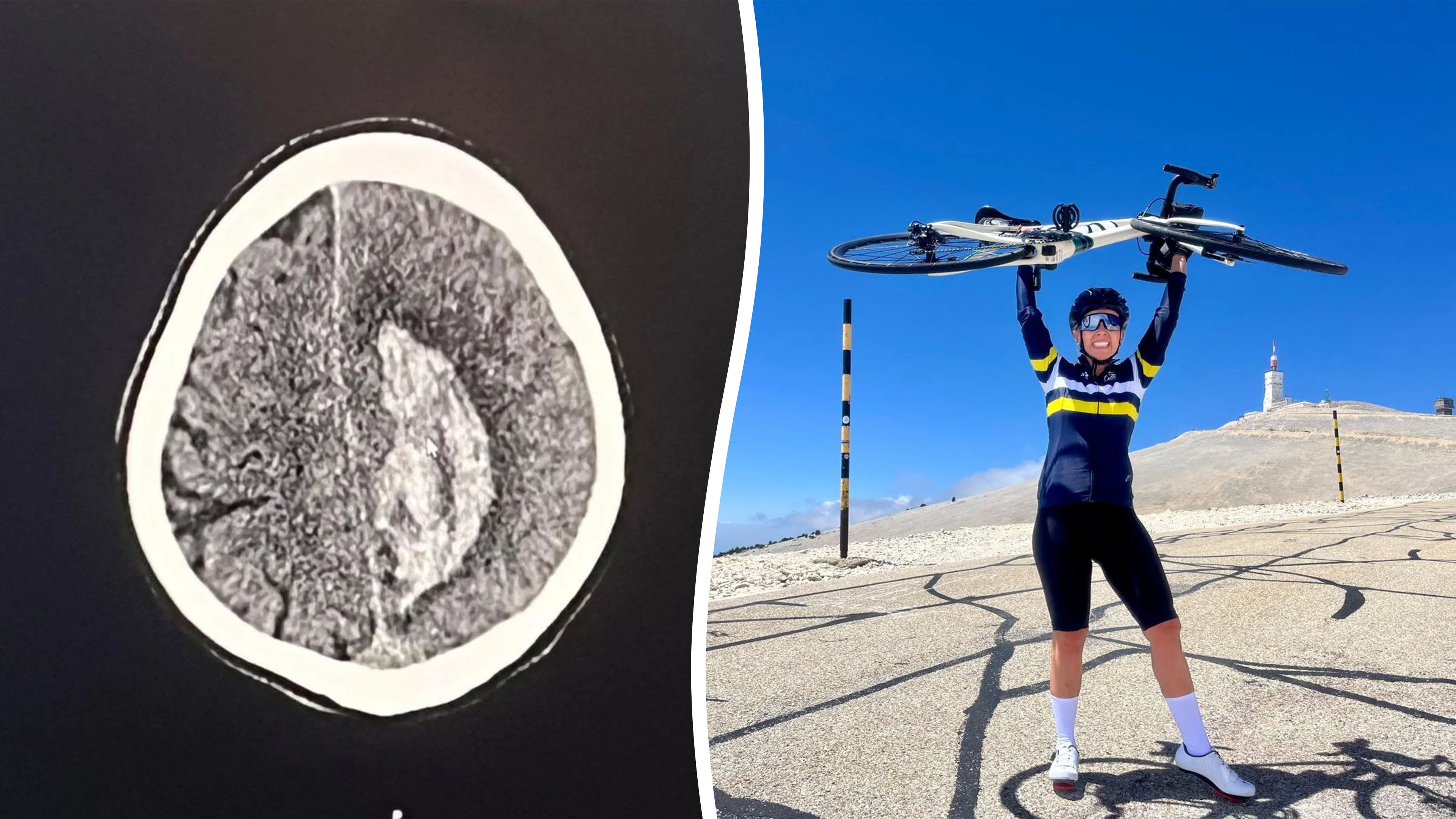 "My work stress headache was actually rare brain disease which left me ...