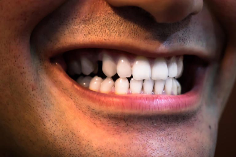 ¿Qué significa soñar que se te caen los dientes?